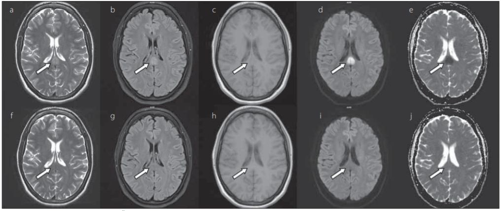 Cytotoxic lesion... | Česká a slovenská neurologie a neurochirurgie