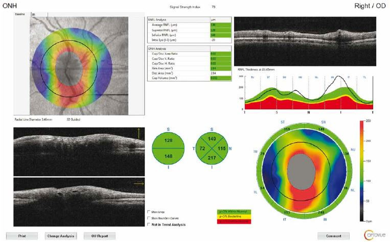 Optical coherenc... | Česká a slovenská neurologie a neurochirurgie
