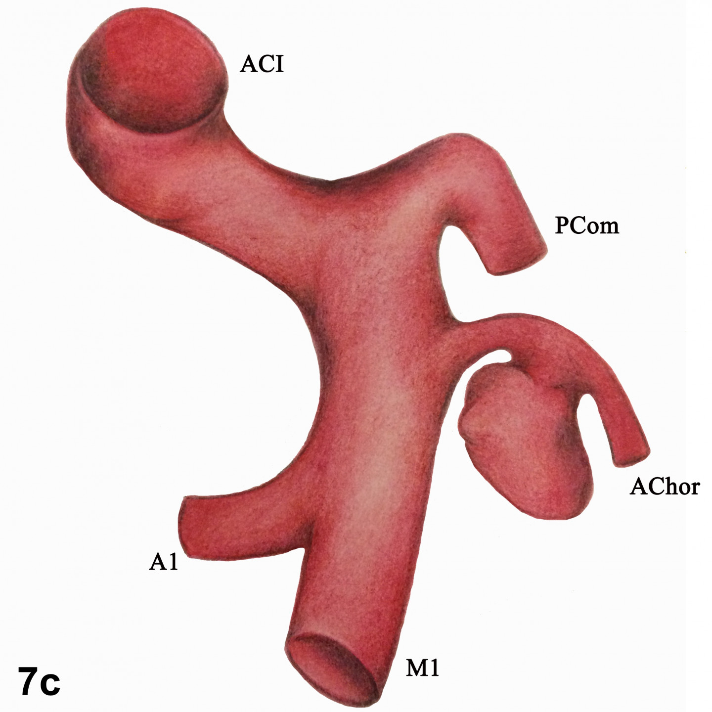 Anterior choroid... | Česká a slovenská neurologie a neurochirurgie